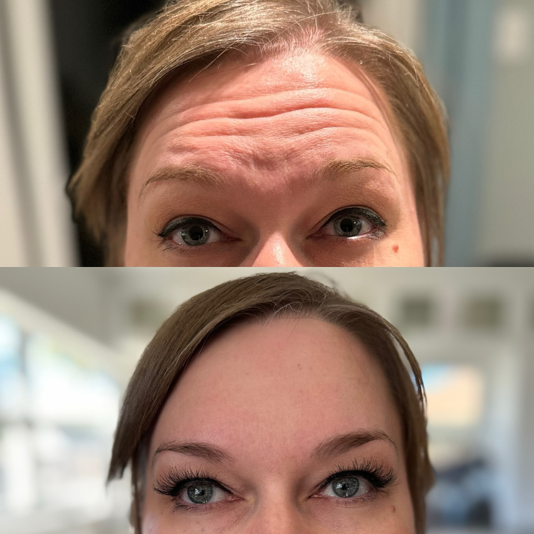 Botox Treatment Areas in Boca Raton | Injection Perfection Medical Spa