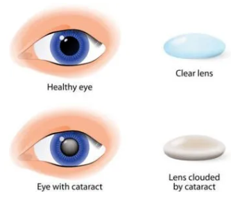 Cataract | Epping Eye Surgery | NSW