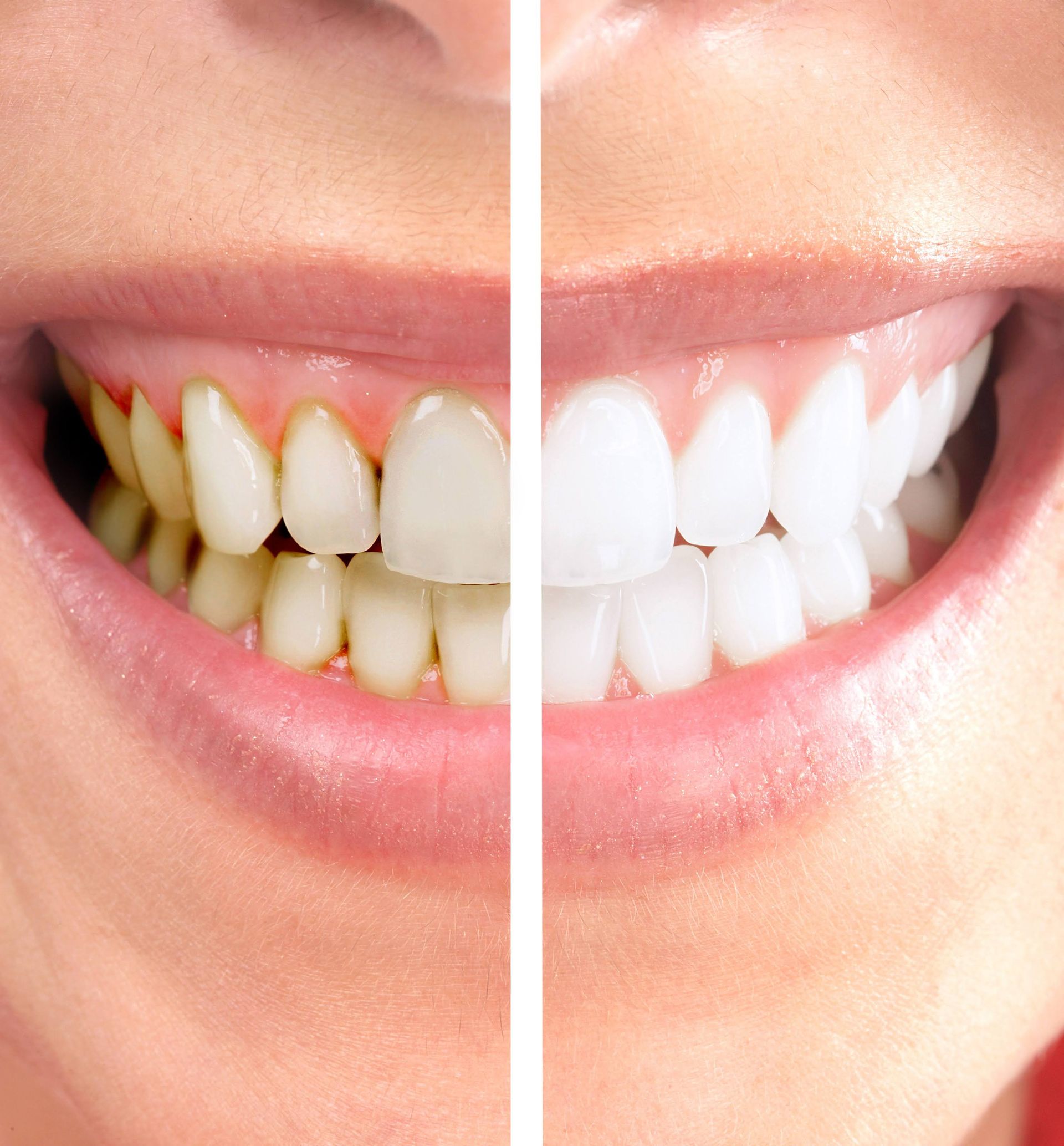 Teeth Discoloration | Koehn Dentistry & Aesthetics