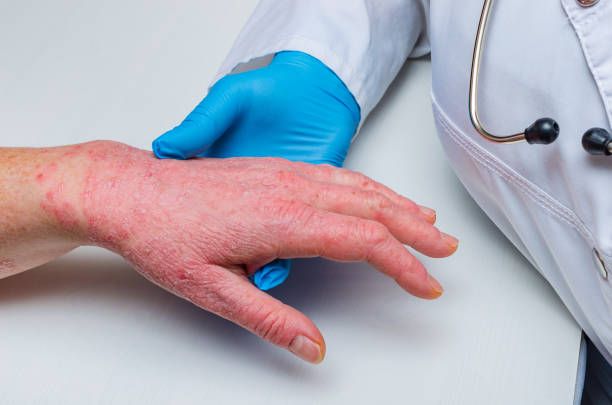 When to Seek Urgent Care for Your Rash