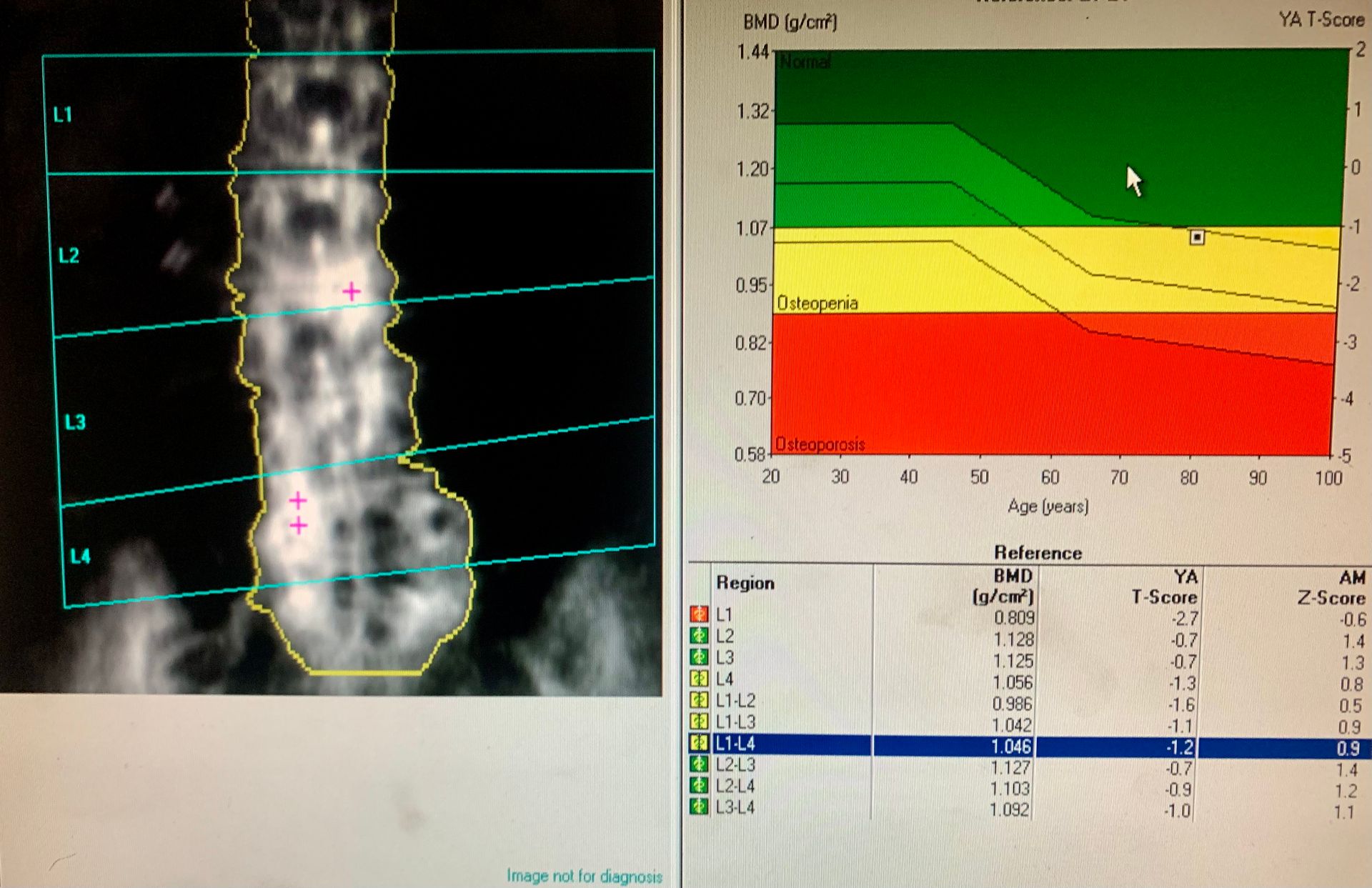 DEXA Scan - LivingWell Radiology - Paducah, KY