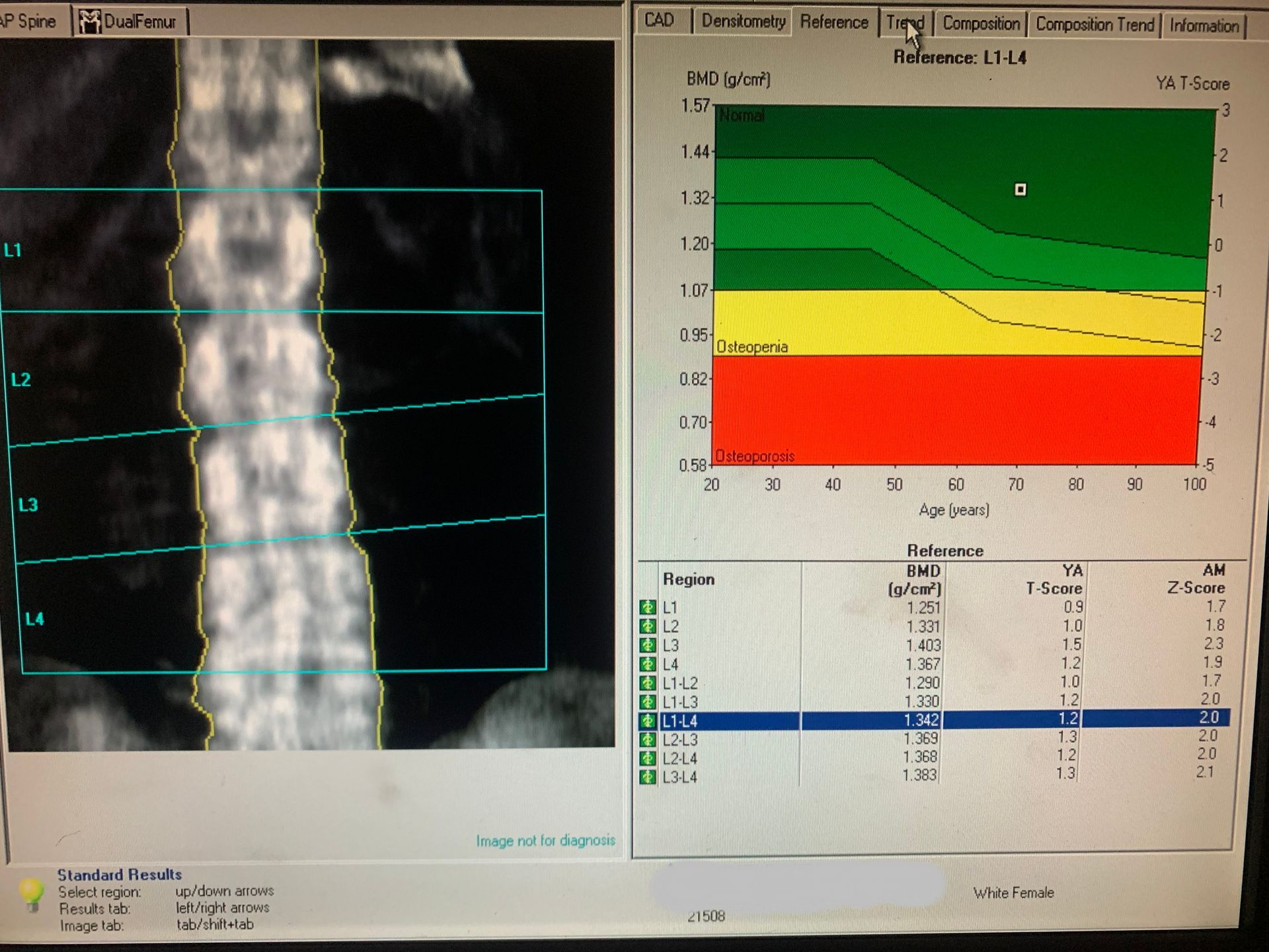 DEXA Scan - LivingWell Radiology - Paducah, KY