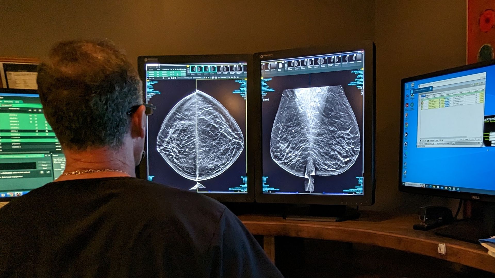 3D Mammogram - LivingWell Radiology - Paducah, KY