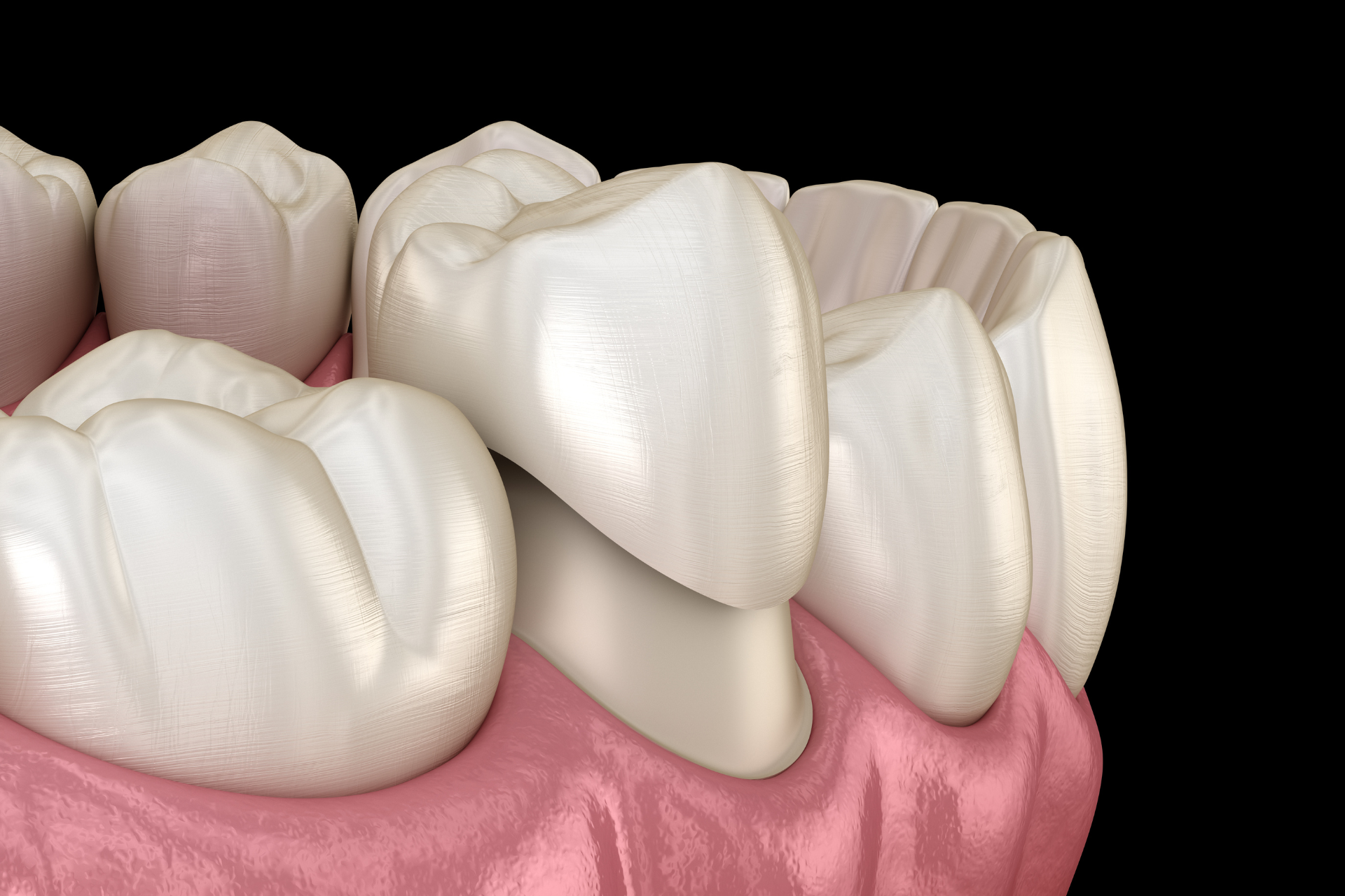 How Strong Are Dental Crowns?