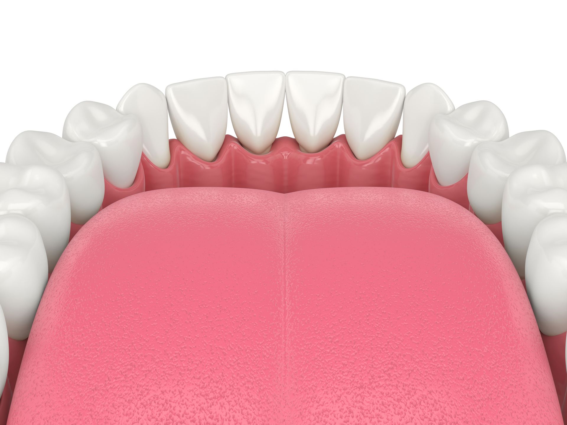 What causes black triangles in teeth?