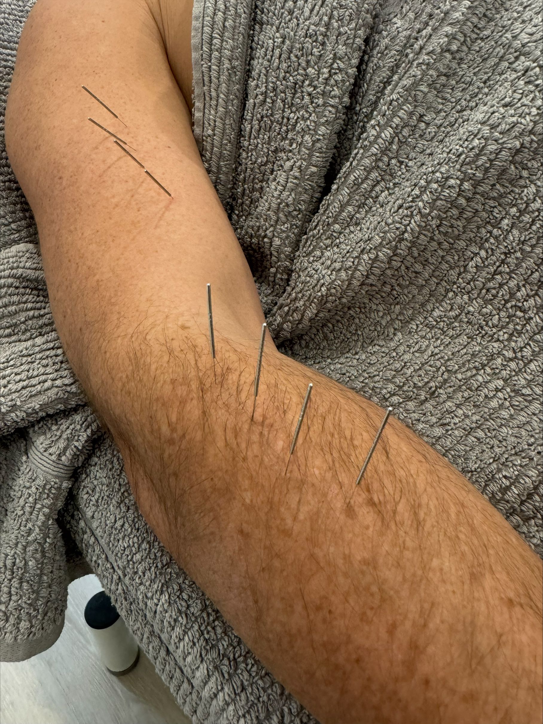 Elbow Pain | PACT Physio & Rehab