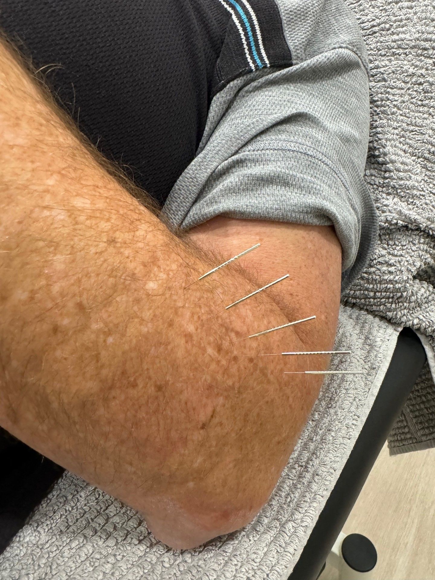 Elbow Pain | PACT Physio & Rehab