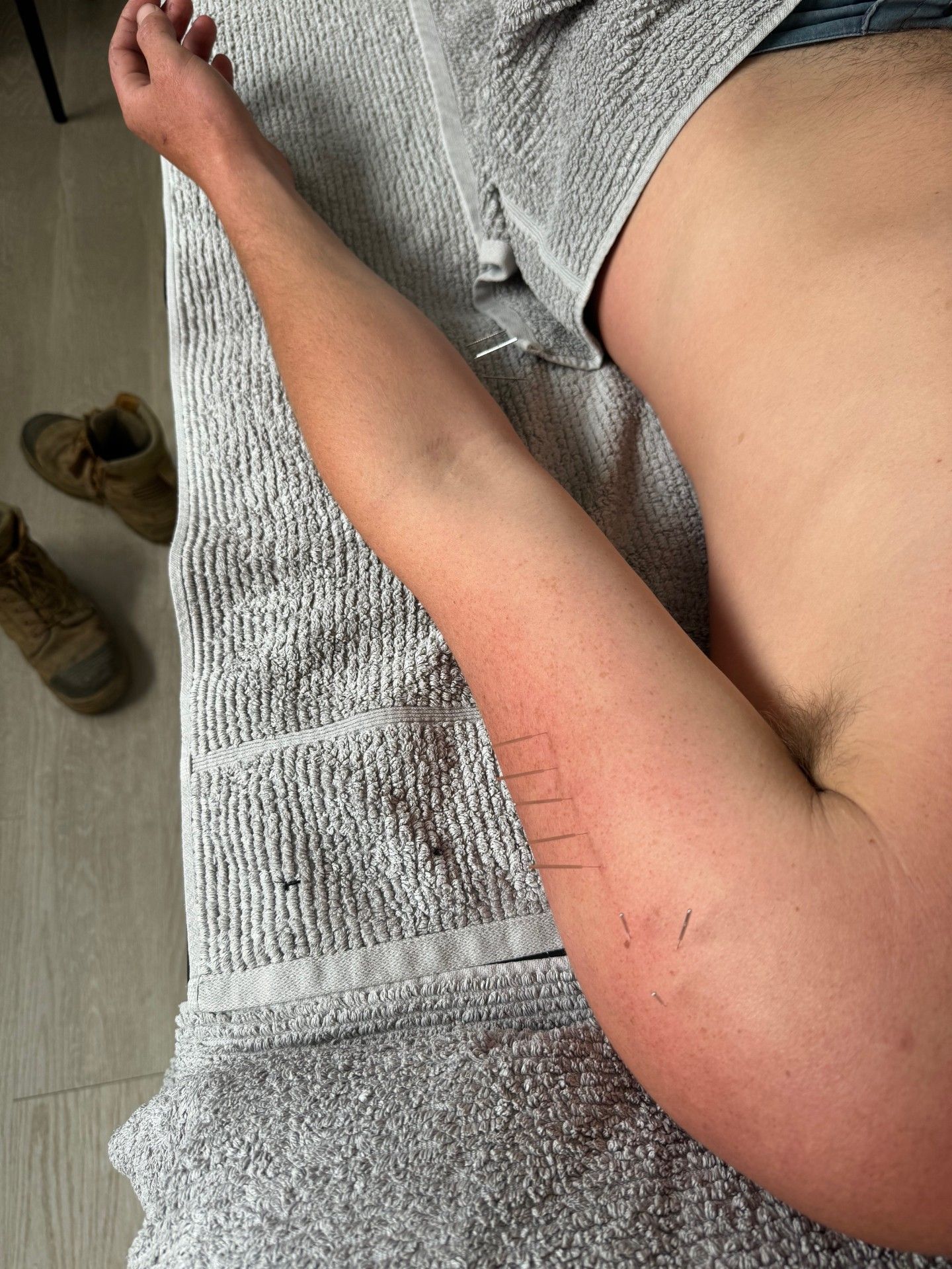 Trigger Point Dry Needling | Sutherland Shire Physio