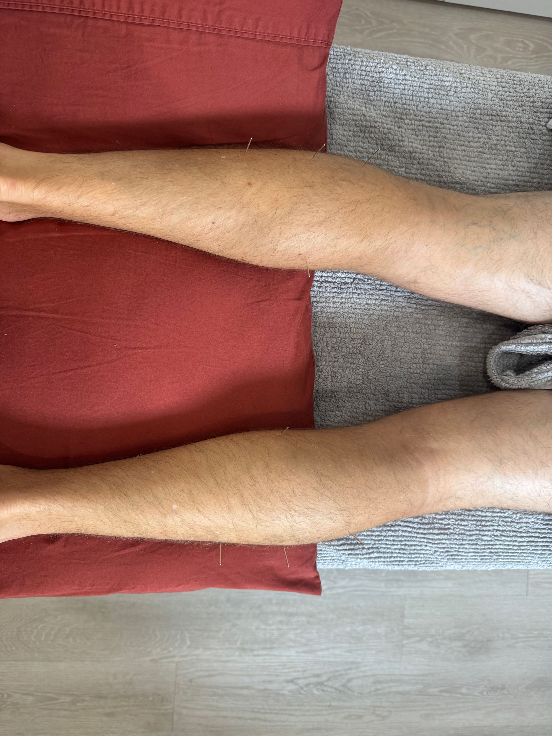 Trigger Point Dry Needling | Sutherland Shire Physio